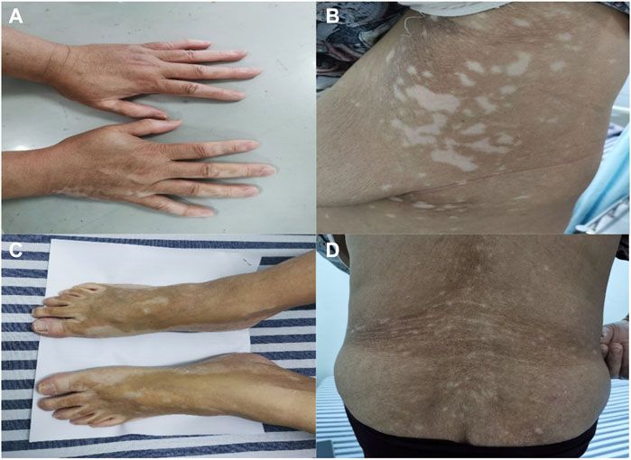 vitiligo cc
