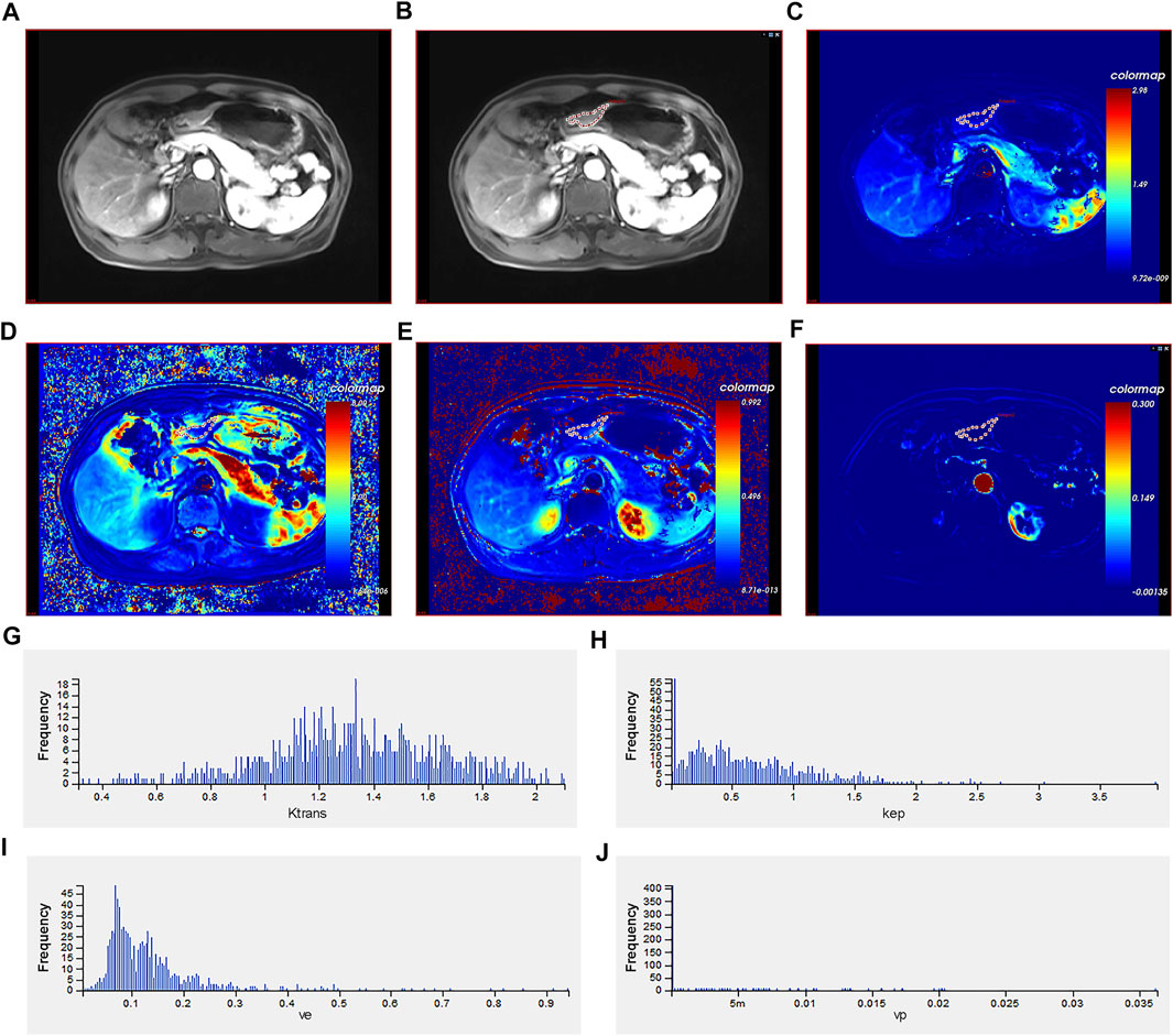 Pathology & Oncology Research | Association Between DCE-MRI Perfusion ...