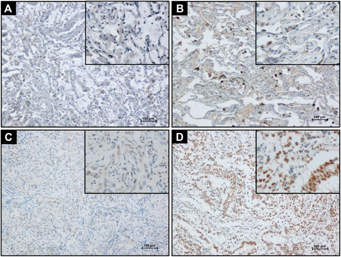 Pathology & Oncology Research | Overexpression of PELP1 in Lung ...